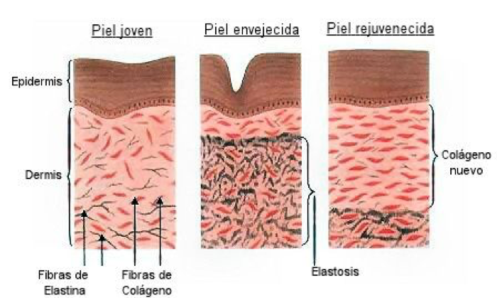 Flaccidez – imel